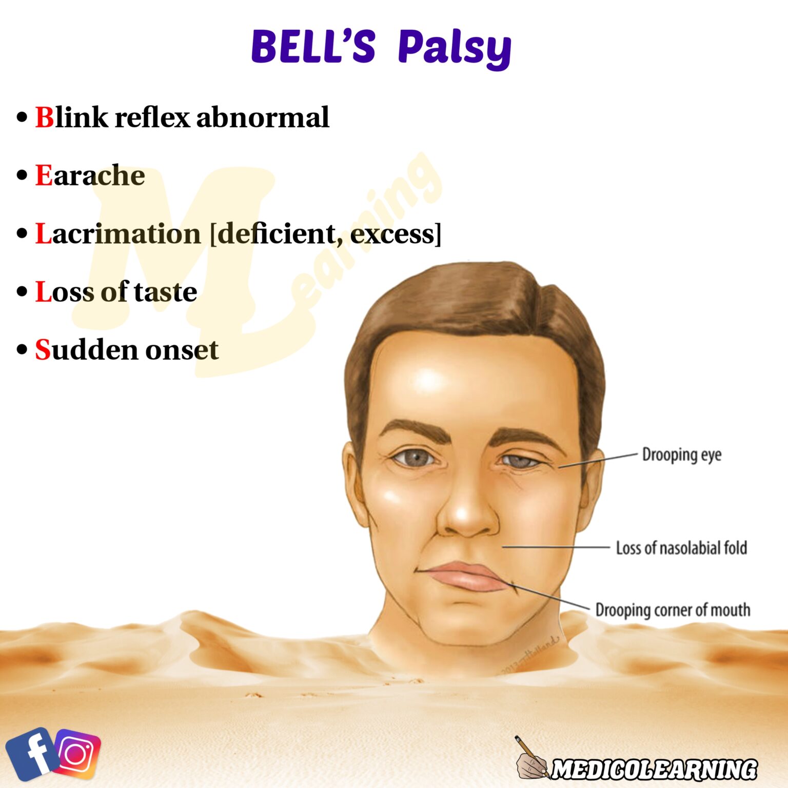 Bells Palsy Mnemonic – MedicoLearning