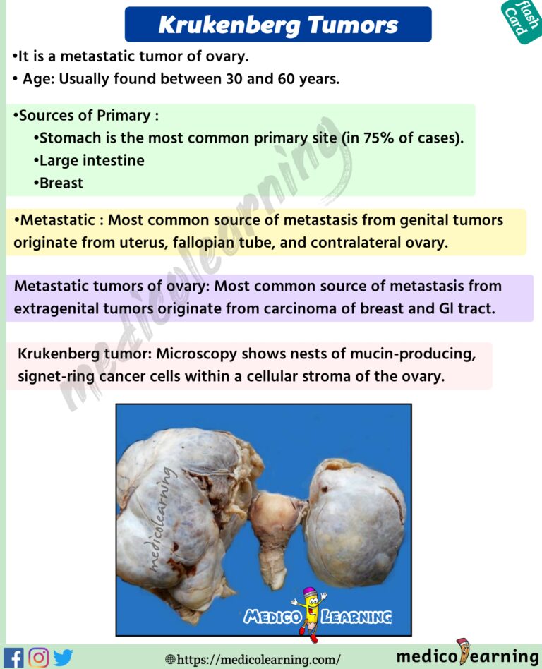 Krukenberg Tumours – MedicoLearning