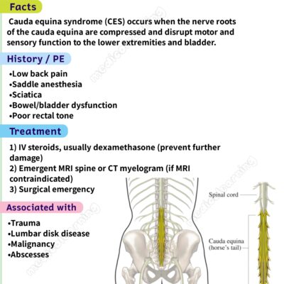 Cauda equina syndrome – MedicoLearning