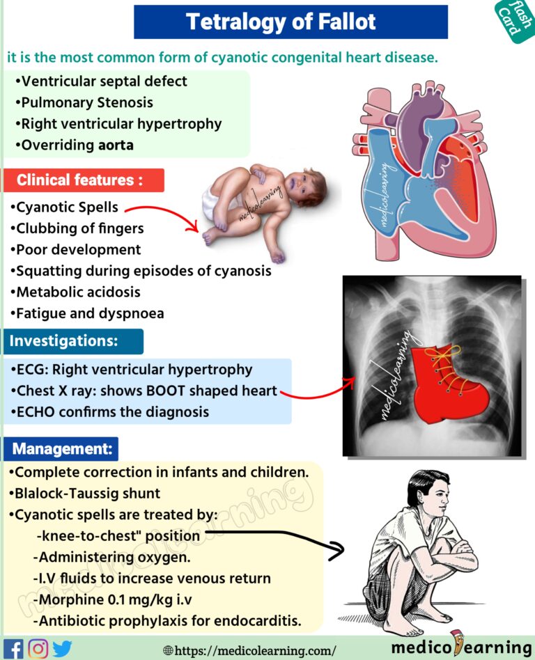Tetralogy of Fallot – MedicoLearning