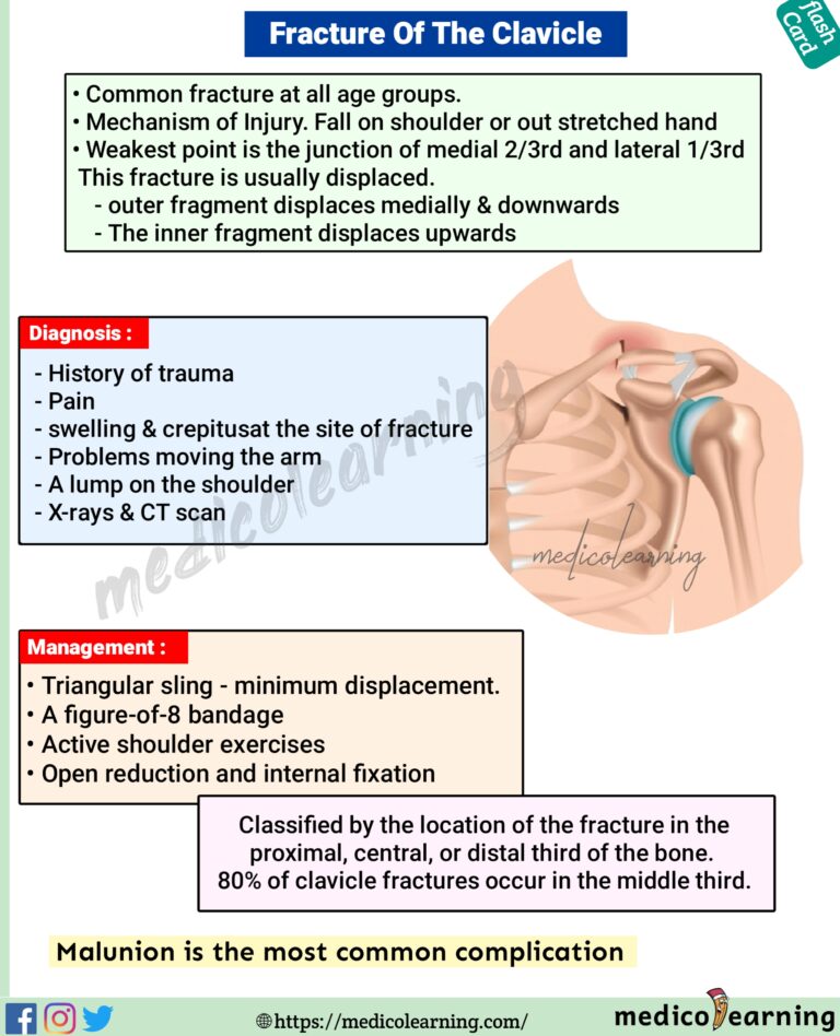Fracture of Clavicle – MedicoLearning