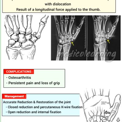 Bennett fracture – MedicoLearning
