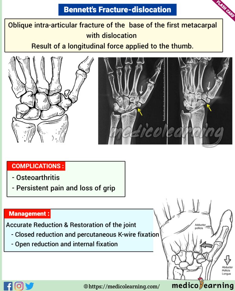 Bennett fracture – MedicoLearning