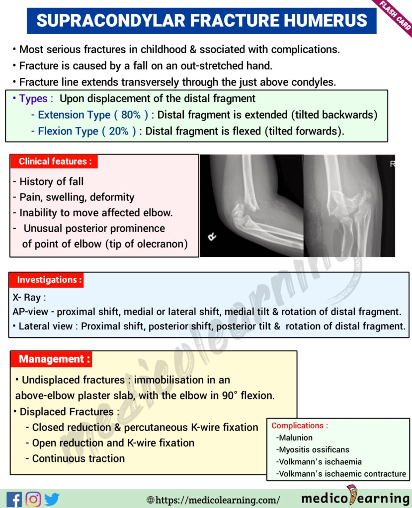 Supracondylar Fracture Of Humerus MedicoLearning Supracondylar Fracture Of Humerus MedicoLearning