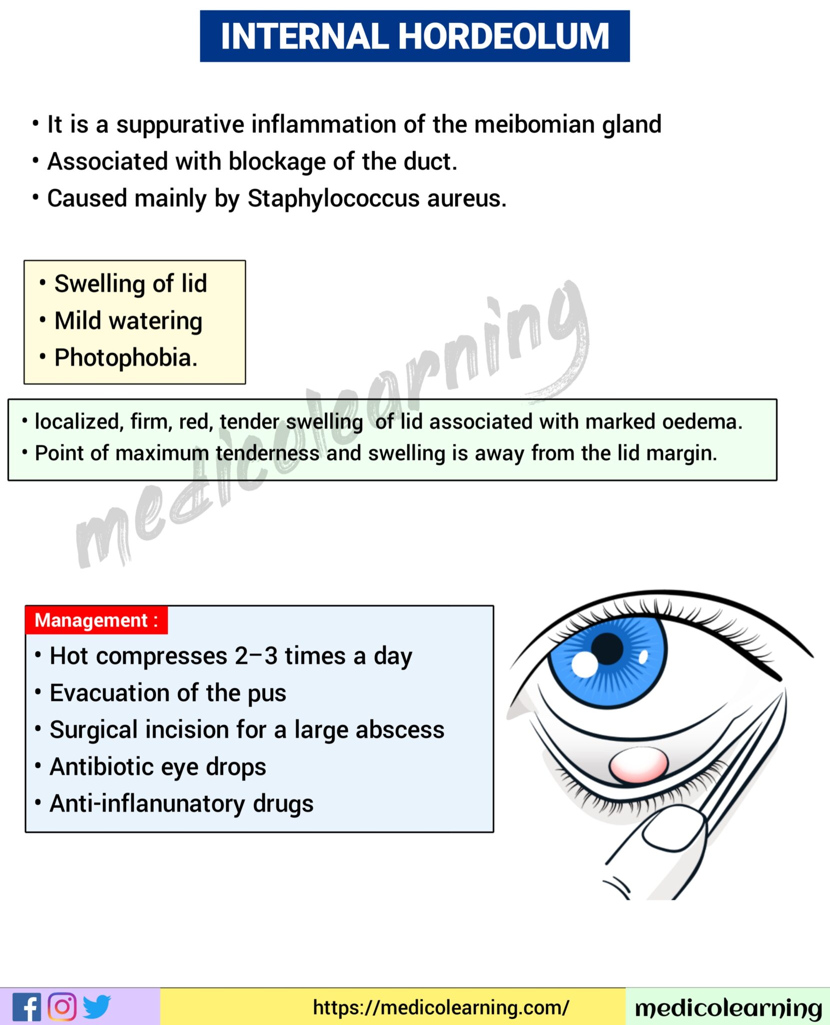 Internal Hordeolum – MedicoLearning