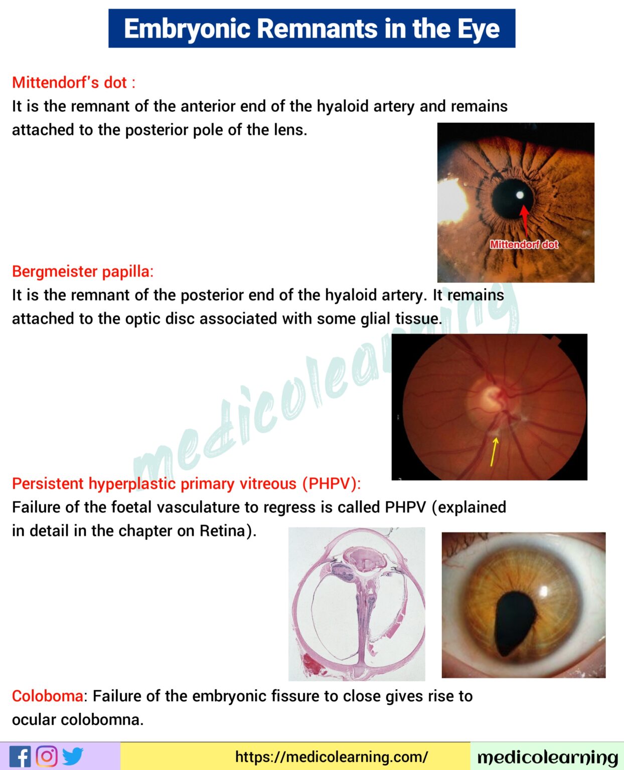 Embryonic Remnants in the Eye – MedicoLearning