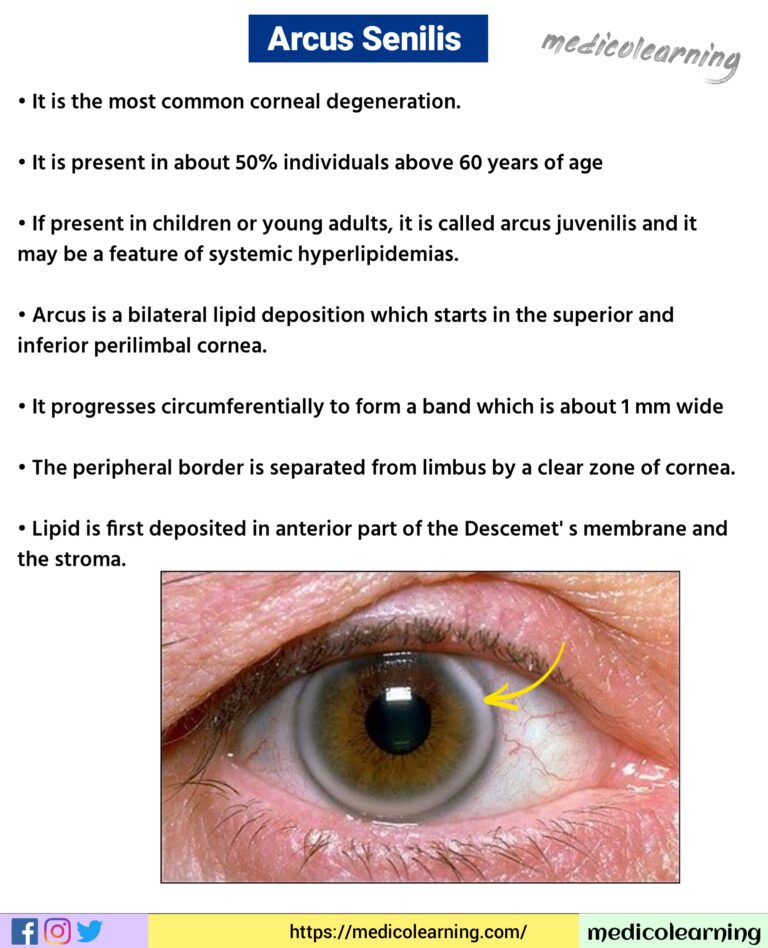 Arcus Senilis – MedicoLearning
